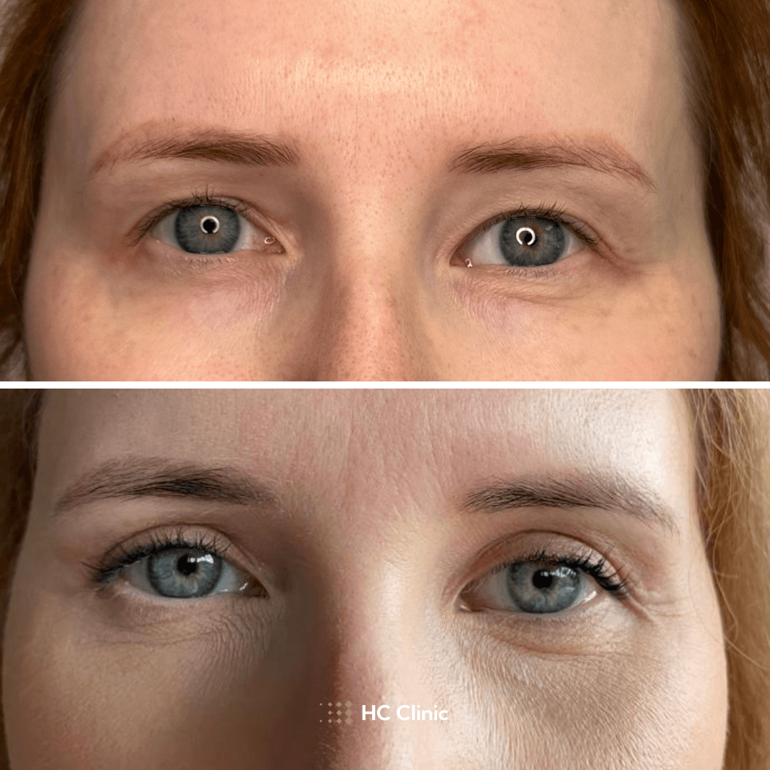 Blefaroplastyka - plastyka powiek we Wrocławiu | HC Clinic